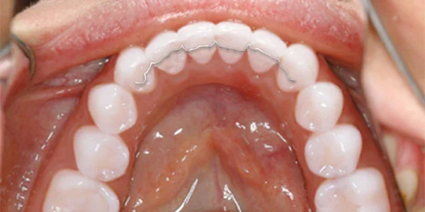 Kieferorthopädie für Erwachsene – Unsichtbare Aligner & moderne Technik ...